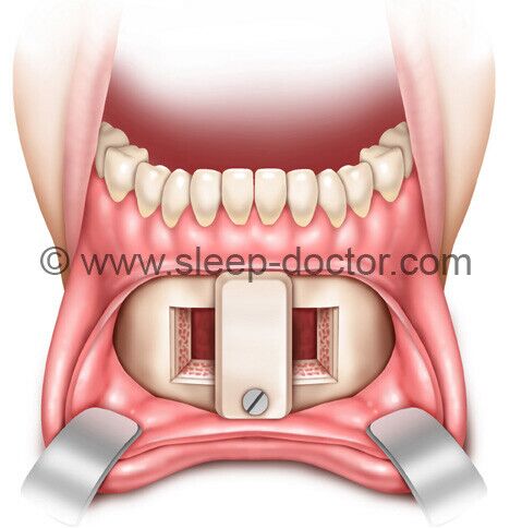 Genioglossus Advancement - Sleep Doctor