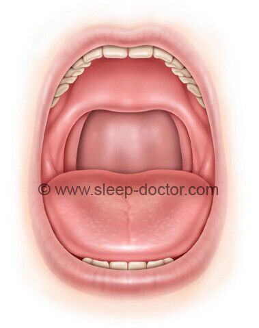 Palate Surgery - Sleep Doctor
