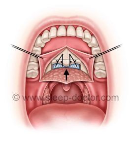 Pallet in mouth store