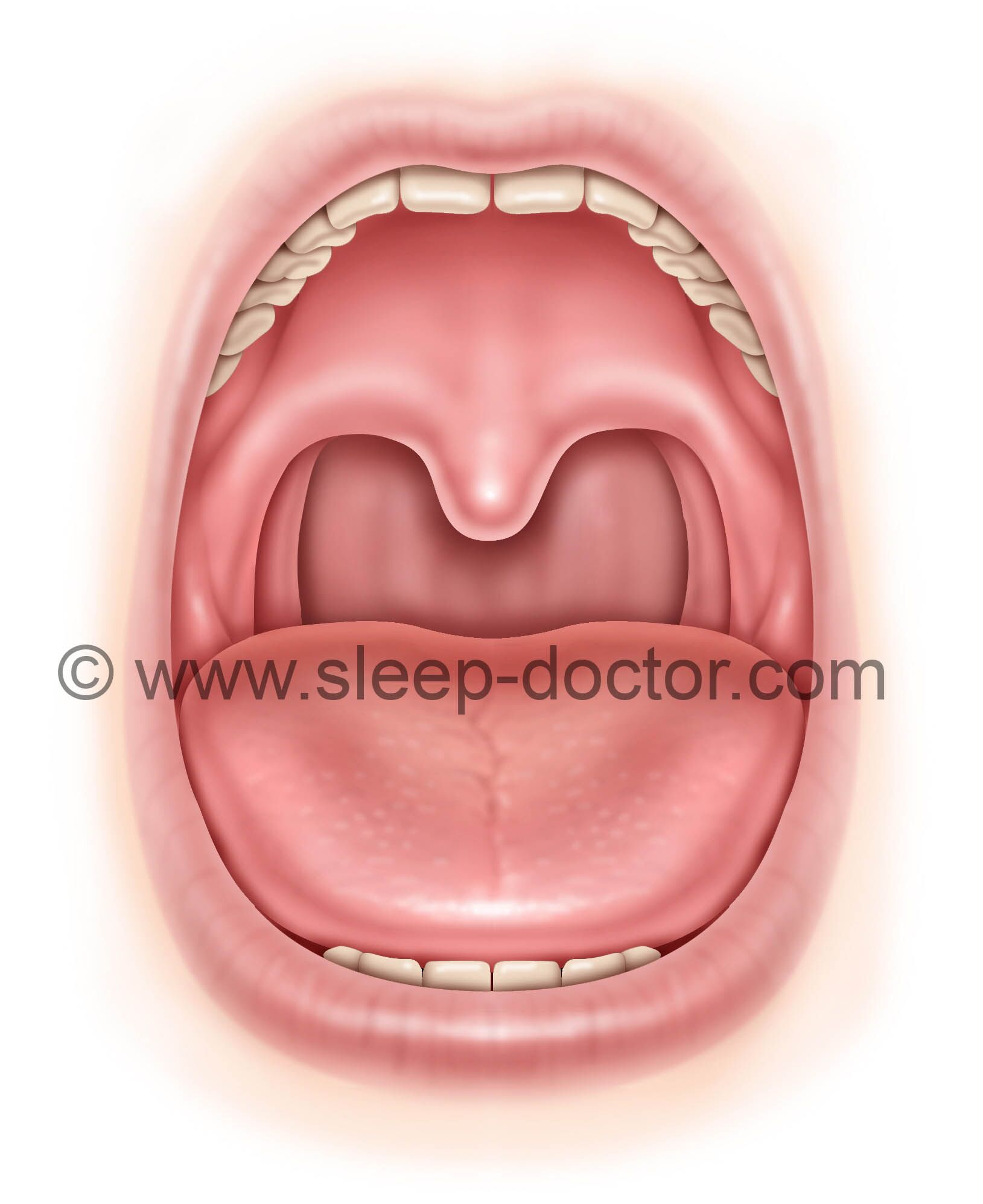 Australian Modified Palatopharyngoplasty - Sleep Doctor